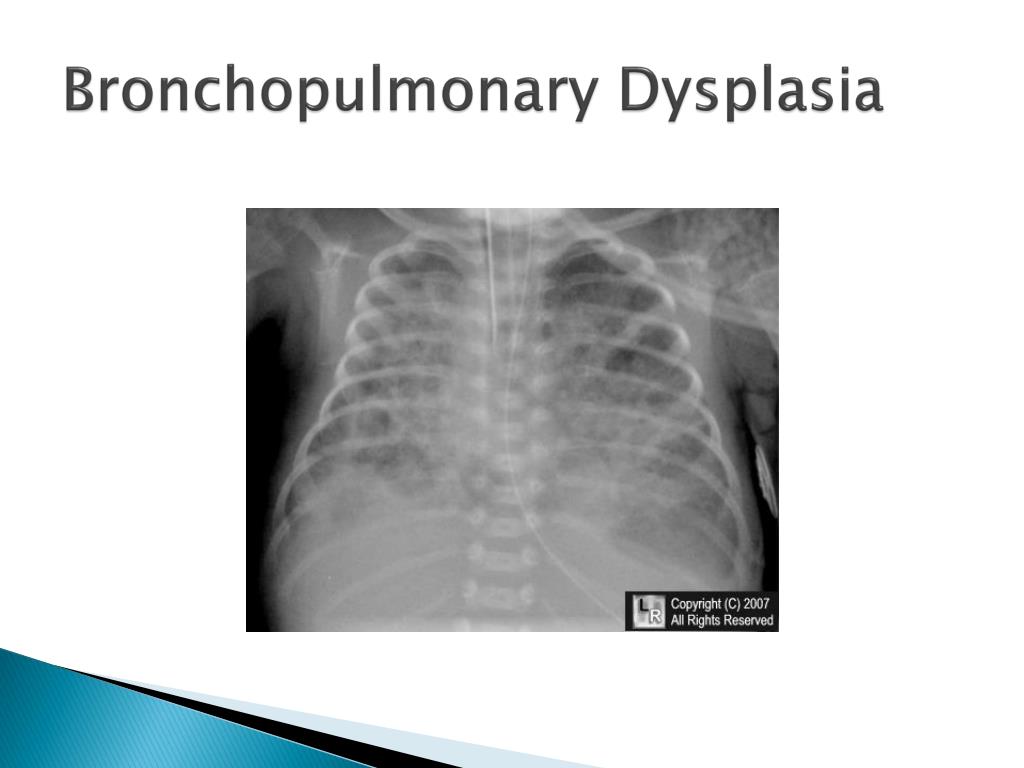PPT - NICU Graduate and Special Needs Children PowerPoint Presentation ...