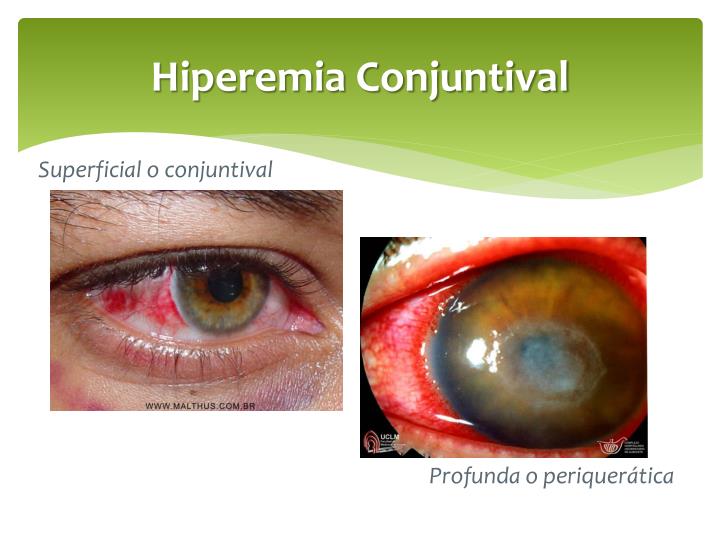 PPT - SINDROME DE OJO ROJO PowerPoint Presentation - ID:3037955