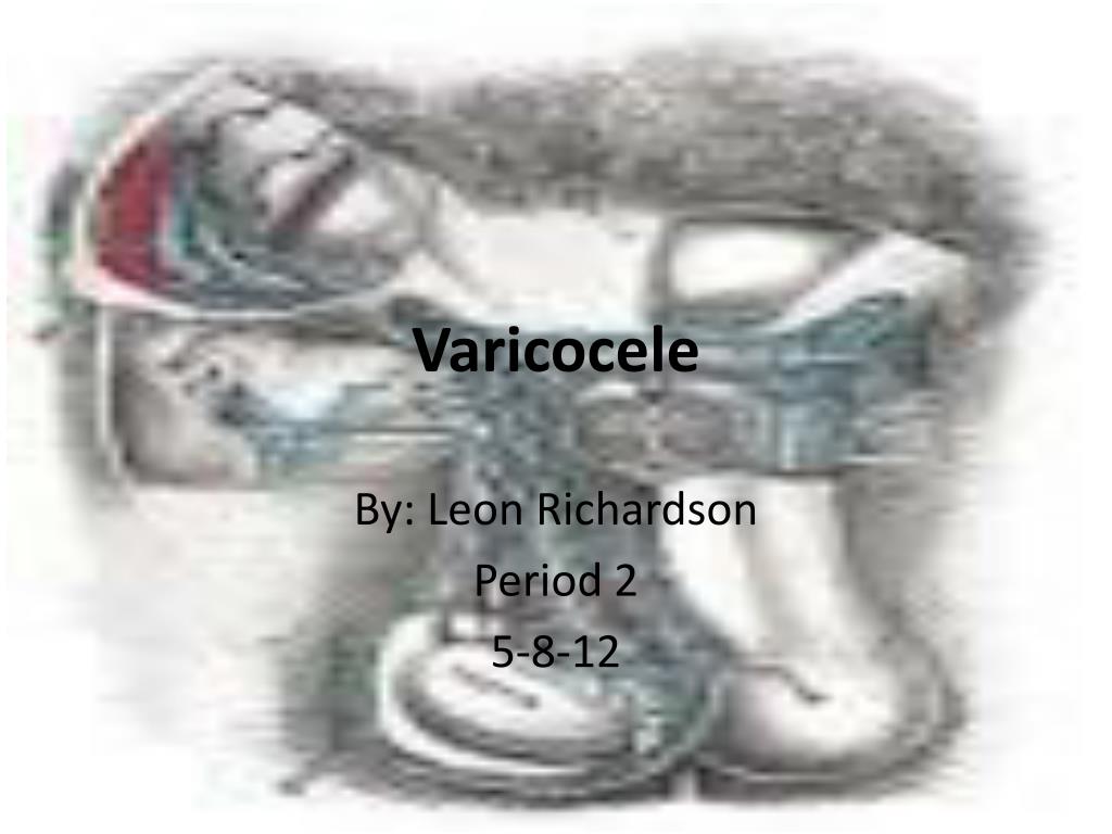 Ppt Varicocele Powerpoint Presentation Free Download Id 3038177