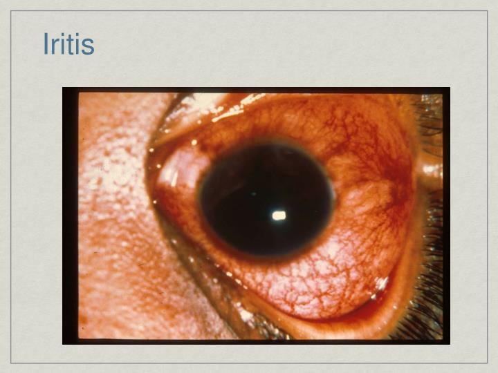 PPT - Trichiasis PowerPoint Presentation - ID:3040688