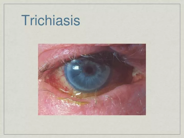 PPT - Trichiasis PowerPoint Presentation, free download - ID:3040688