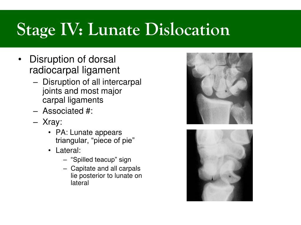 Lunate Dislocation Pie Sign