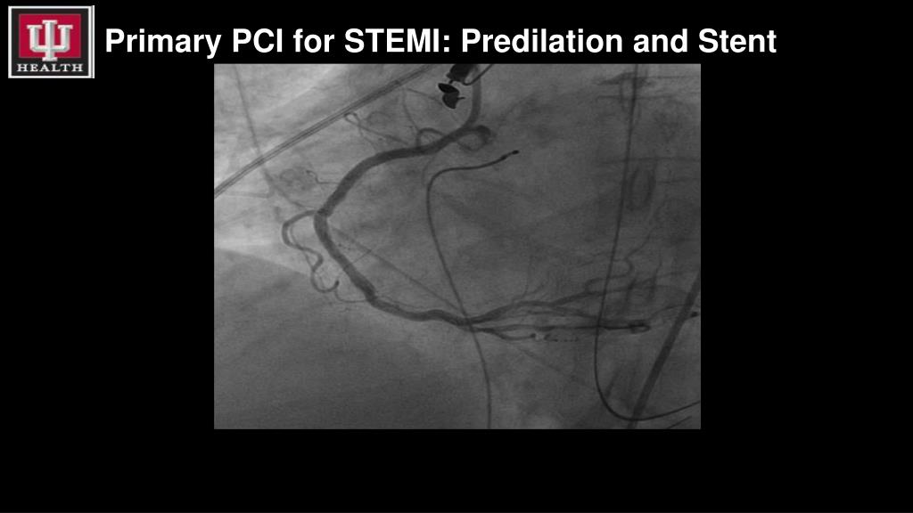 PPT - Thrombus Management in STEMI PCI: Results and Evolution in ...
