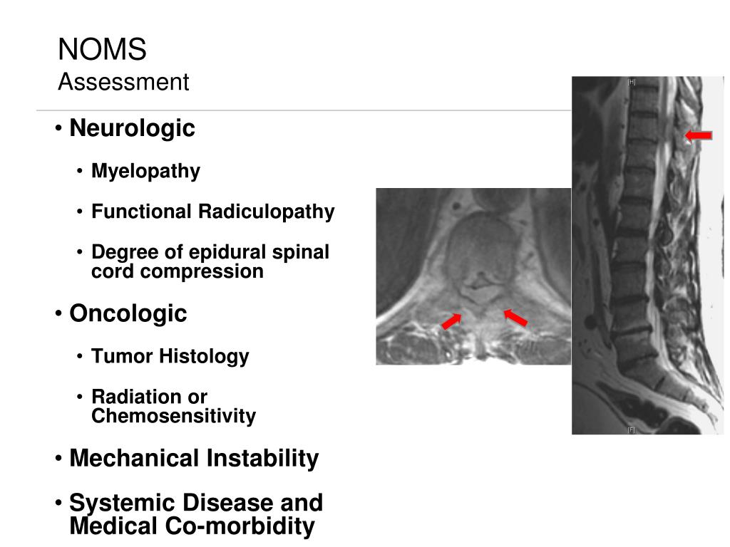 PPT - SPINE SBRT: The MSKCC Spine Service IAEA Singapore SBRT Symposium ...