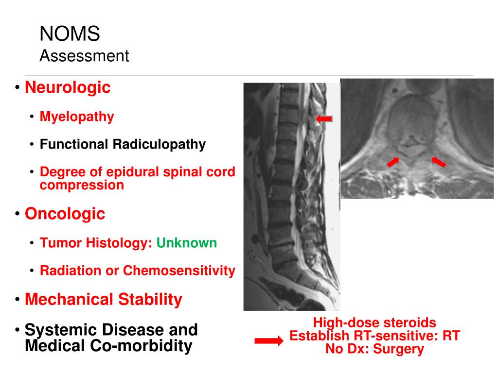 PPT - SPINE SBRT: The MSKCC Spine Service IAEA Singapore SBRT Symposium ...