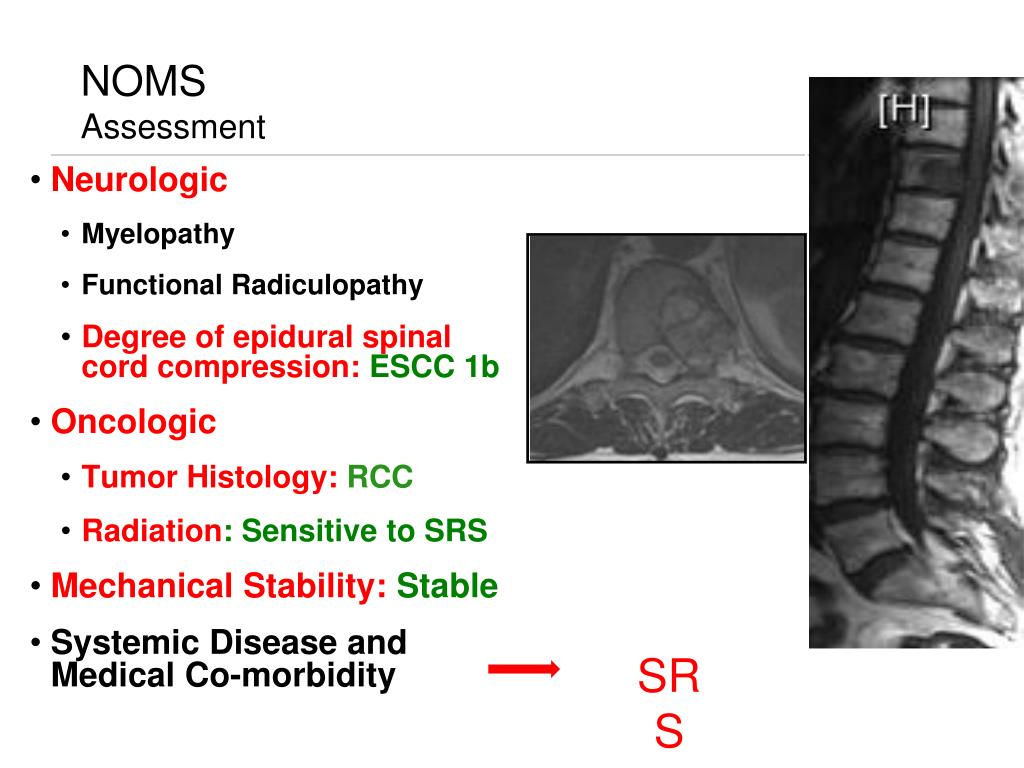 PPT - SPINE SBRT: The MSKCC Spine Service IAEA Singapore SBRT Symposium ...