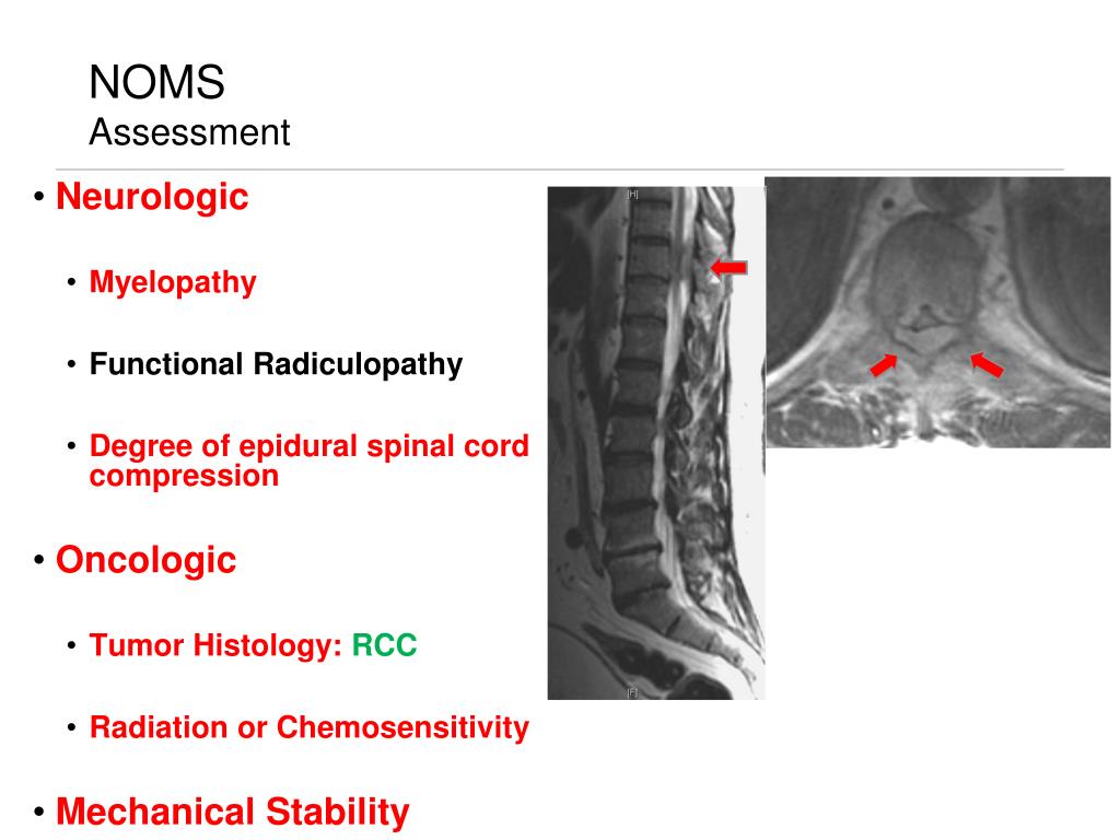 PPT - SPINE SBRT: The MSKCC Spine Service IAEA Singapore SBRT Symposium ...