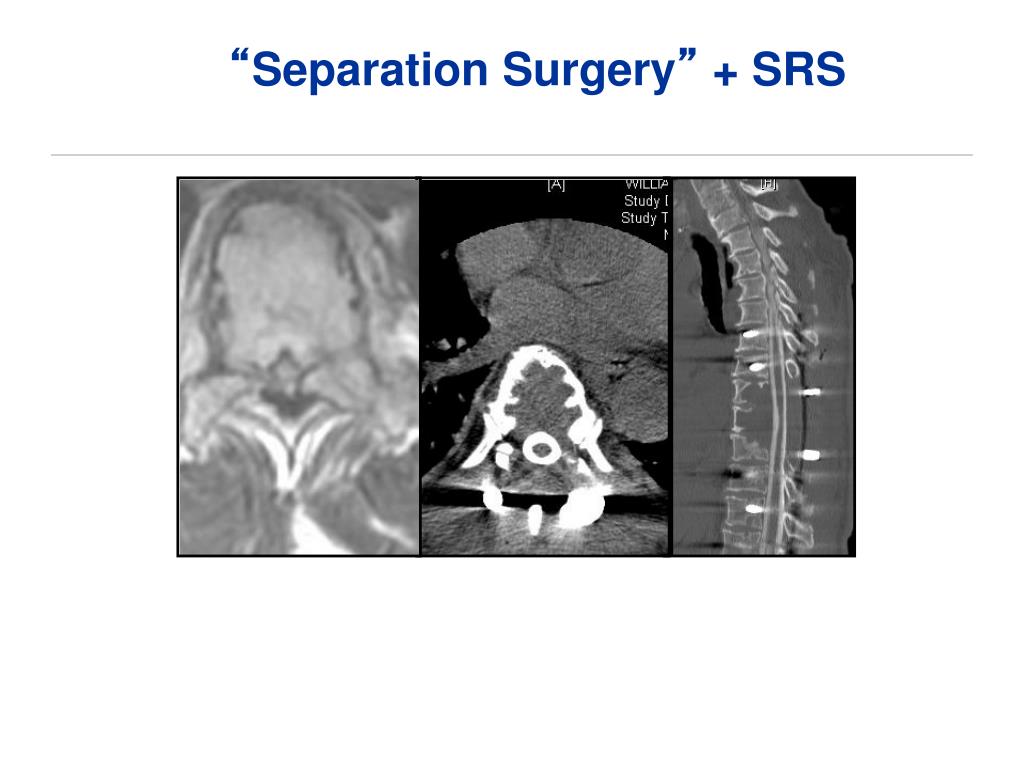 PPT - SPINE SBRT: The MSKCC Spine Service IAEA Singapore SBRT Symposium ...