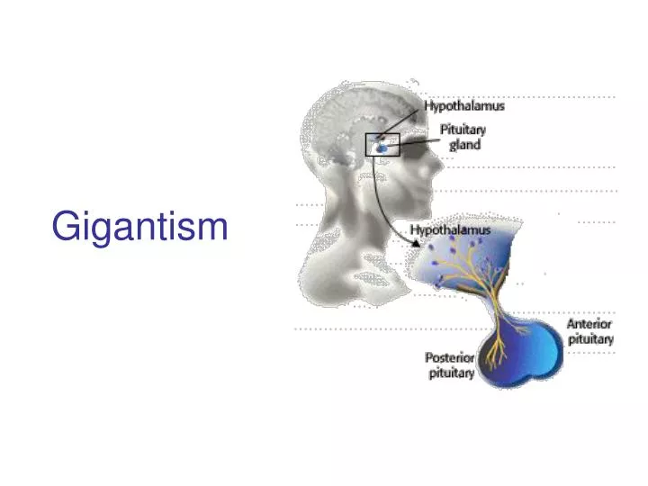 PPT - Gigantism PowerPoint Presentation, free download - ID:3042392