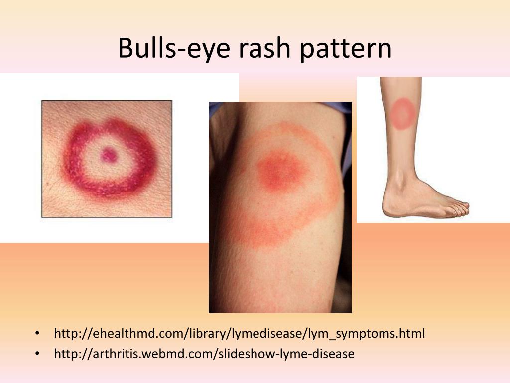 PPT - Lyme Disease PowerPoint Presentation, free download - ID:3042684