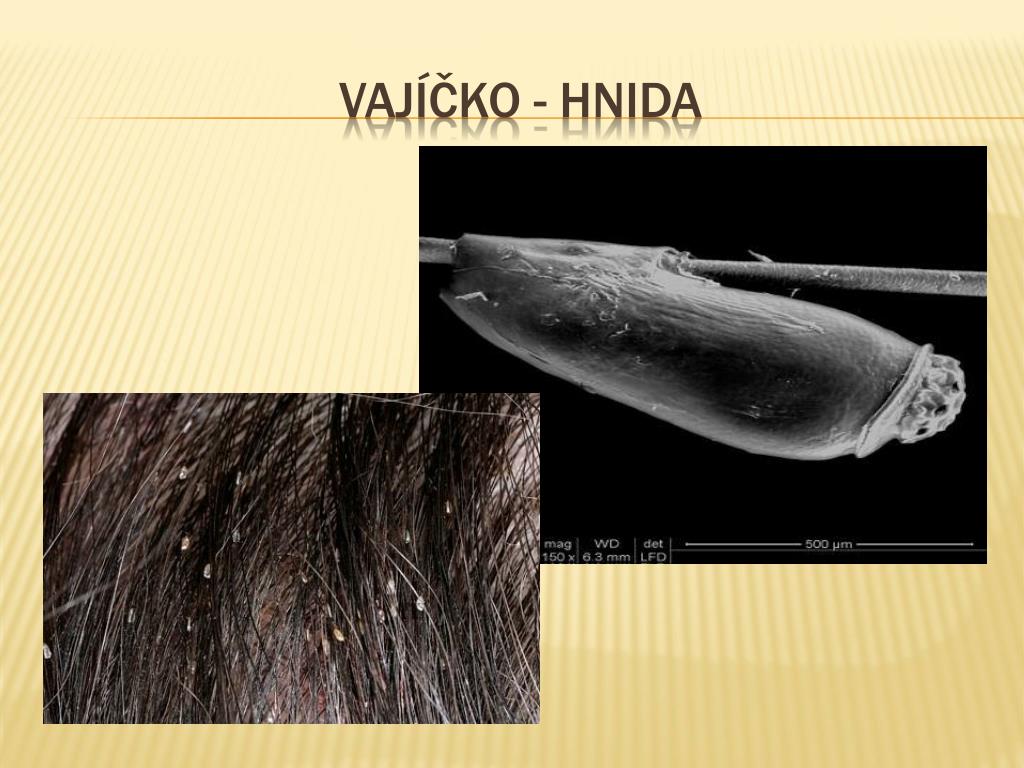 PPT - Prevencia proti pedikulóze (zavšiveniu) PowerPoint Presentation ...