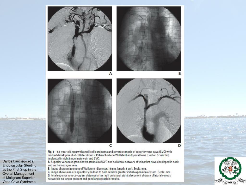 PPT - Management of Superior Vena Cava Syndrome Perspective from ...