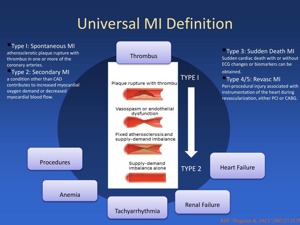 PPT - Cardiovascular Care of Older Adults: Acute Myocardial Infarction ...