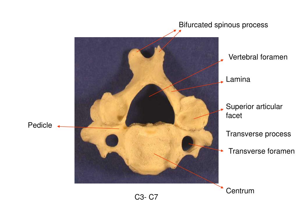 Bifurcated Spinous Process