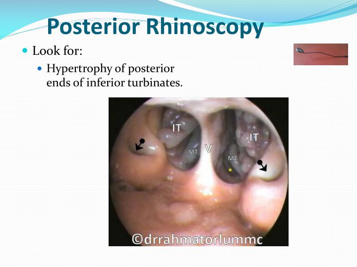 PPT - introduction to ENT History and Clinical Examination PowerPoint ...