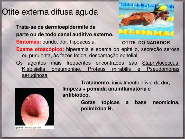 PPT - OTITEs PowerPoint Presentation - ID:3055967
