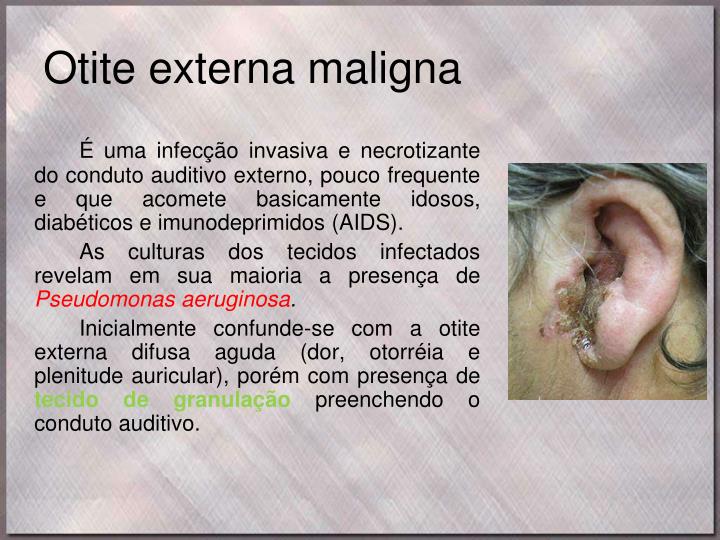 PPT - OTITEs PowerPoint Presentation - ID:3055967