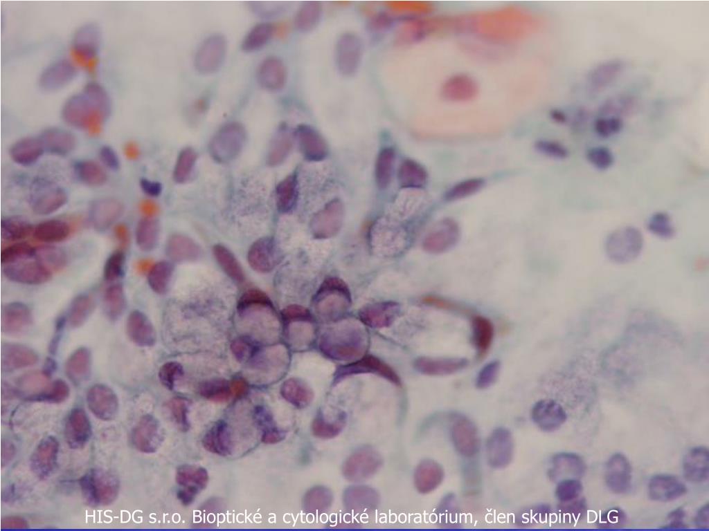 PPT - Včasná epidermoidná metaplázia, možný diagnostický problém ...