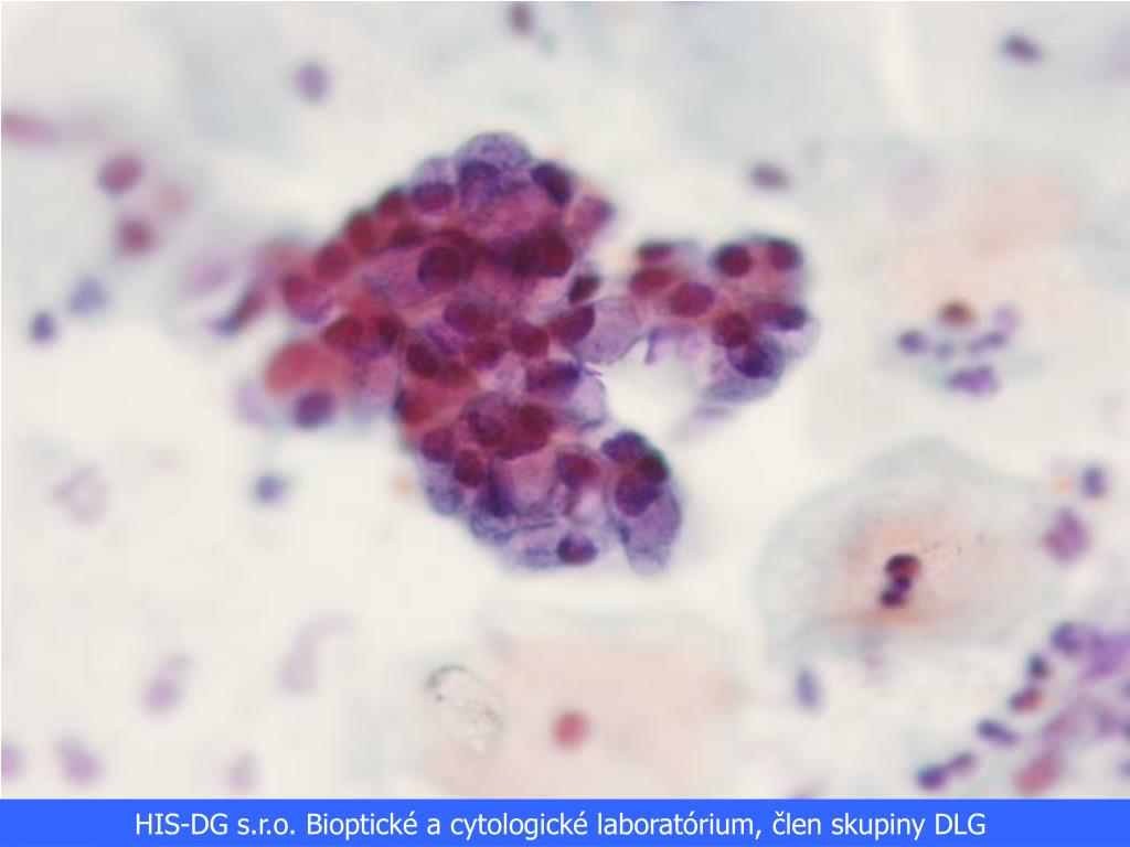 PPT - Včasná epidermoidná metaplázia, možný diagnostický problém ...