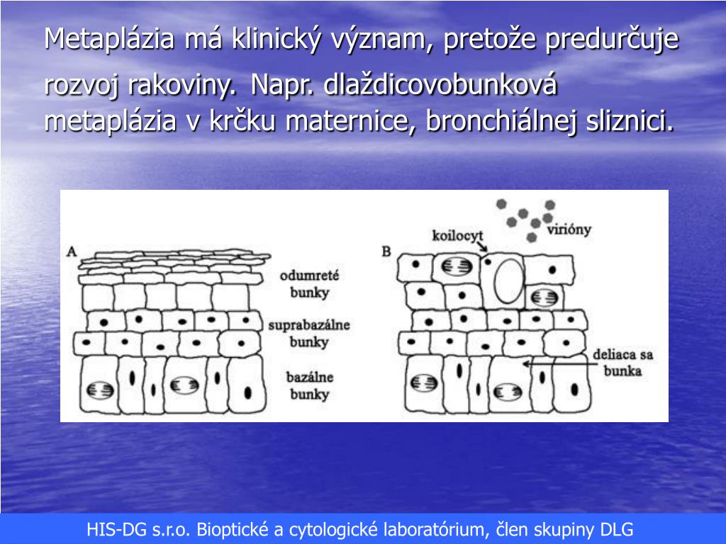 PPT - Včasná epidermoidná metaplázia, možný diagnostický problém ...