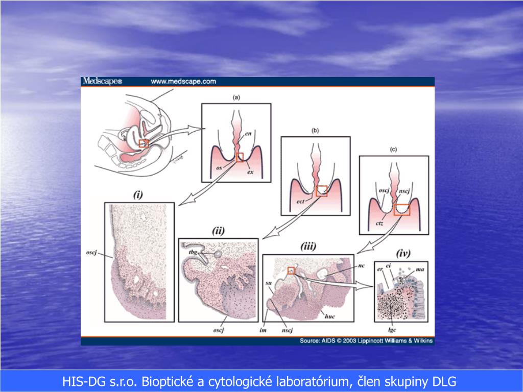 PPT - Včasná epidermoidná metaplázia, možný diagnostický problém ...