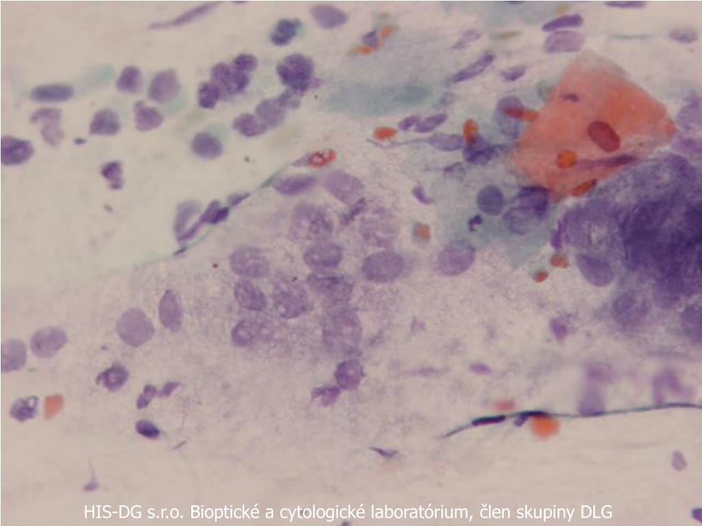 PPT - Včasná epidermoidná metaplázia, možný diagnostický problém ...