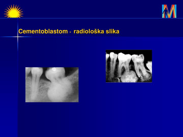 PPT - Odontogeni tumori i ciste čeljusti Tade Tadić PowerPoint ...