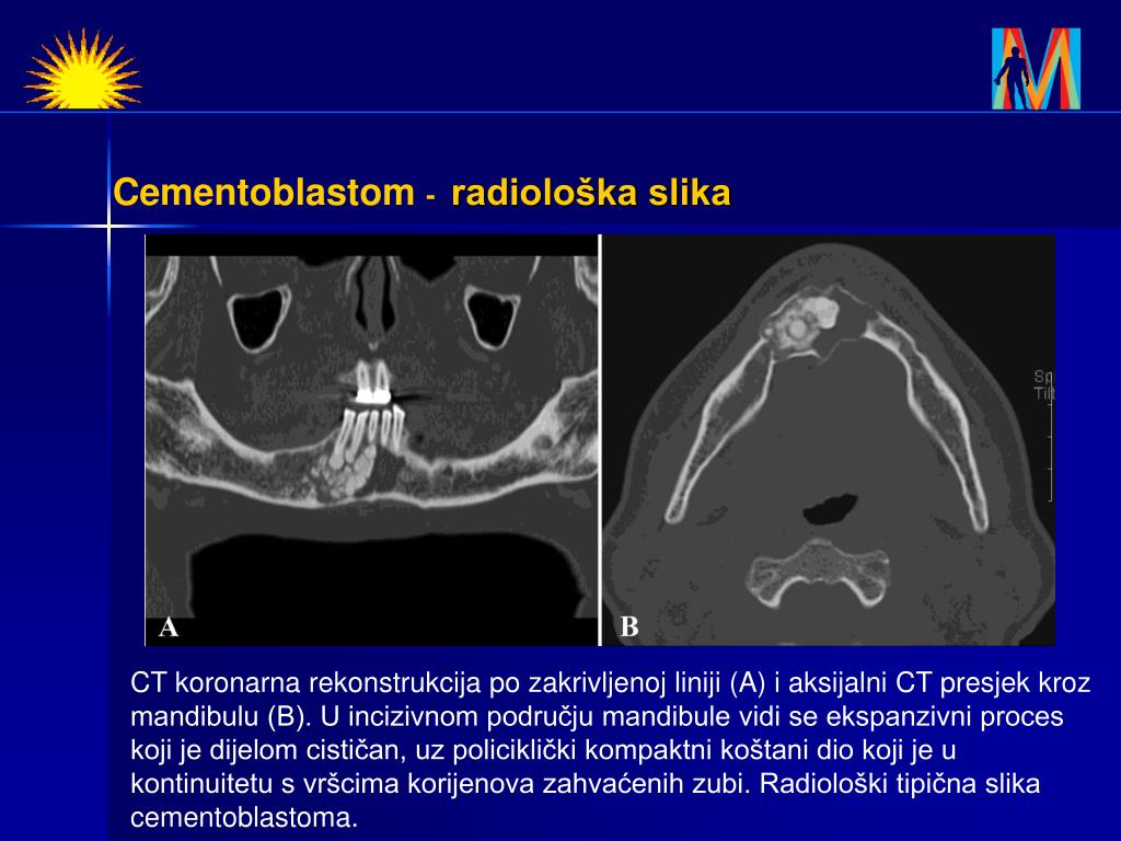 PPT - Odontogeni tumori i ciste čeljusti Tade Tadić PowerPoint ...
