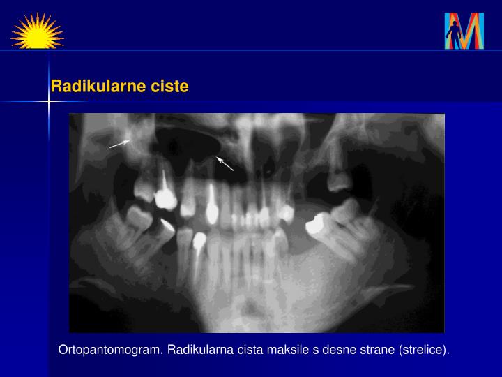 PPT - Odontogeni tumori i ciste čeljusti Tade Tadić PowerPoint ...