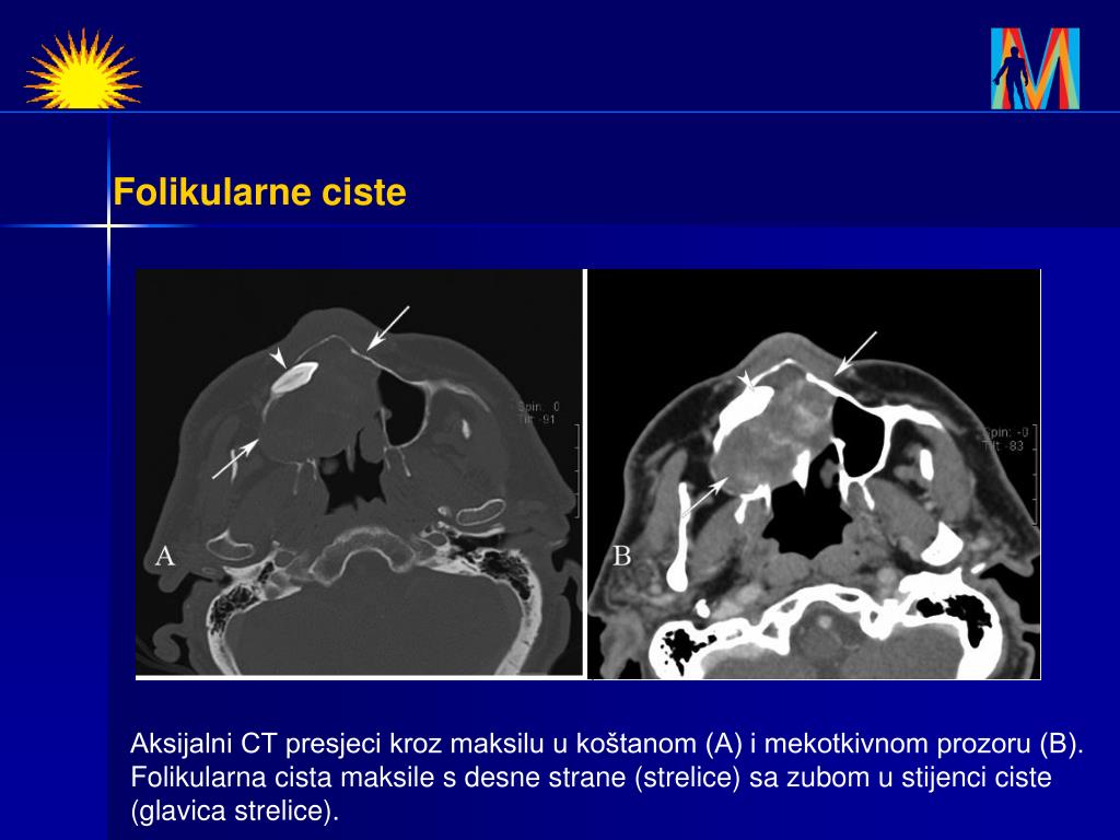 PPT - Odontogeni tumori i ciste čeljusti Tade Tadić PowerPoint ...