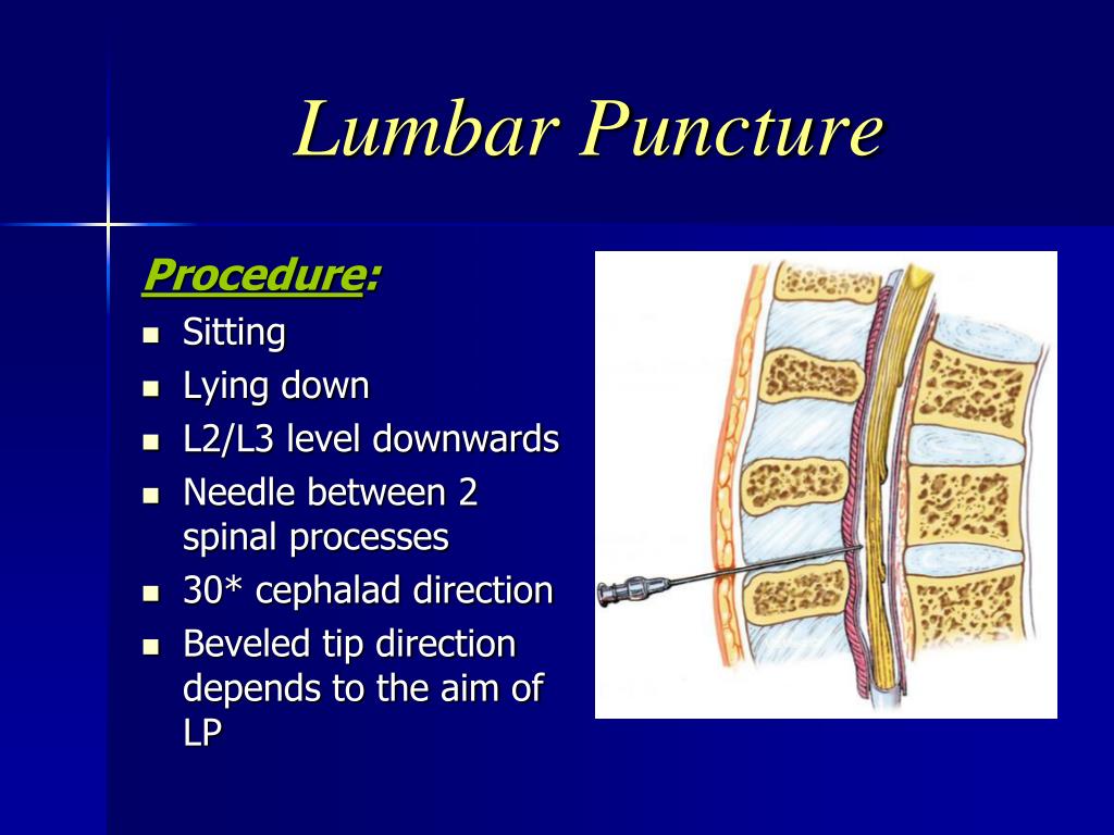 PPT - Lumbar Puncture PowerPoint Presentation, free download - ID:3060338 PPT - Lumbar Puncture PowerPoint Presentation, free download - ID:3060338