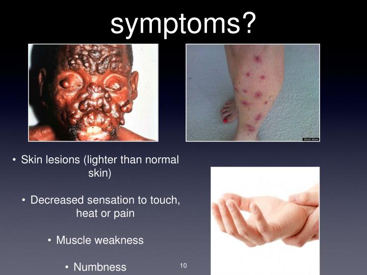 PPT - Leprosy PowerPoint Presentation - ID:3060390