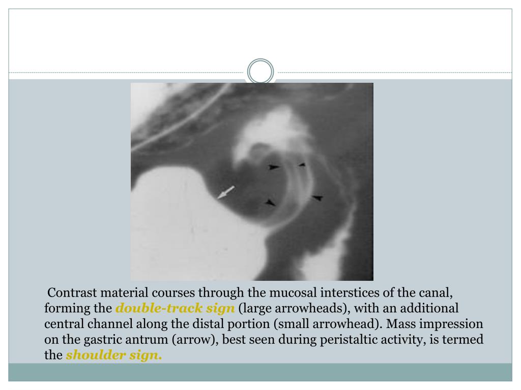 PPT - Gastroesophageal Reflux Disease in Infants PowerPoint ...