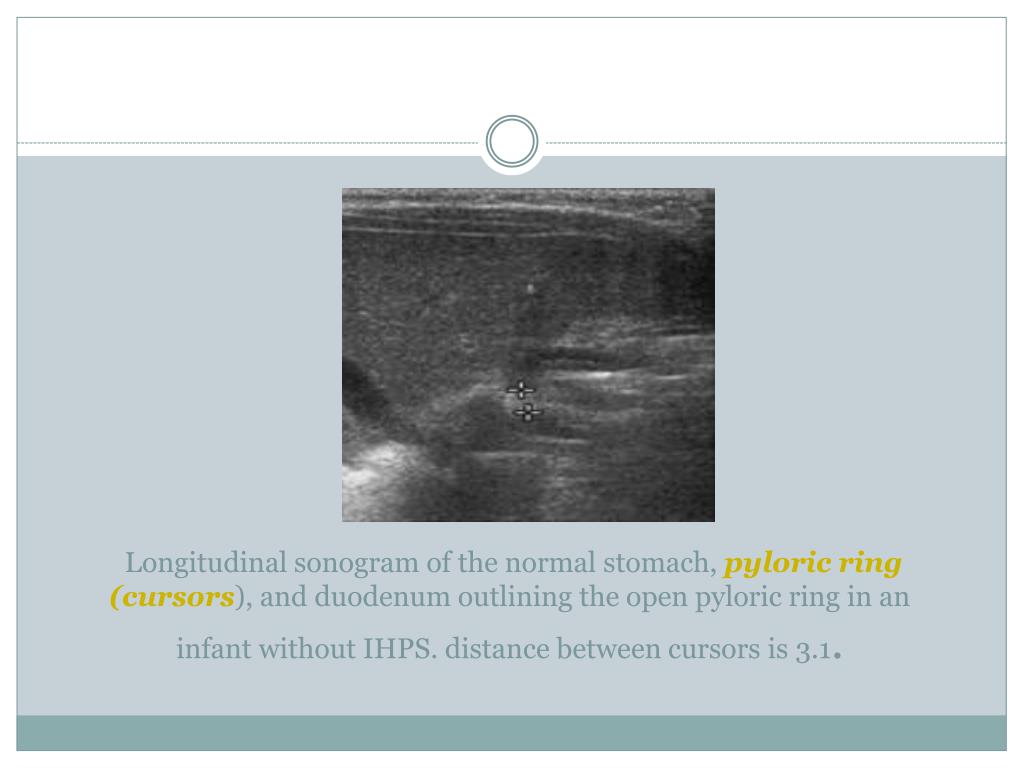 PPT - Gastroesophageal Reflux Disease in Infants PowerPoint ...