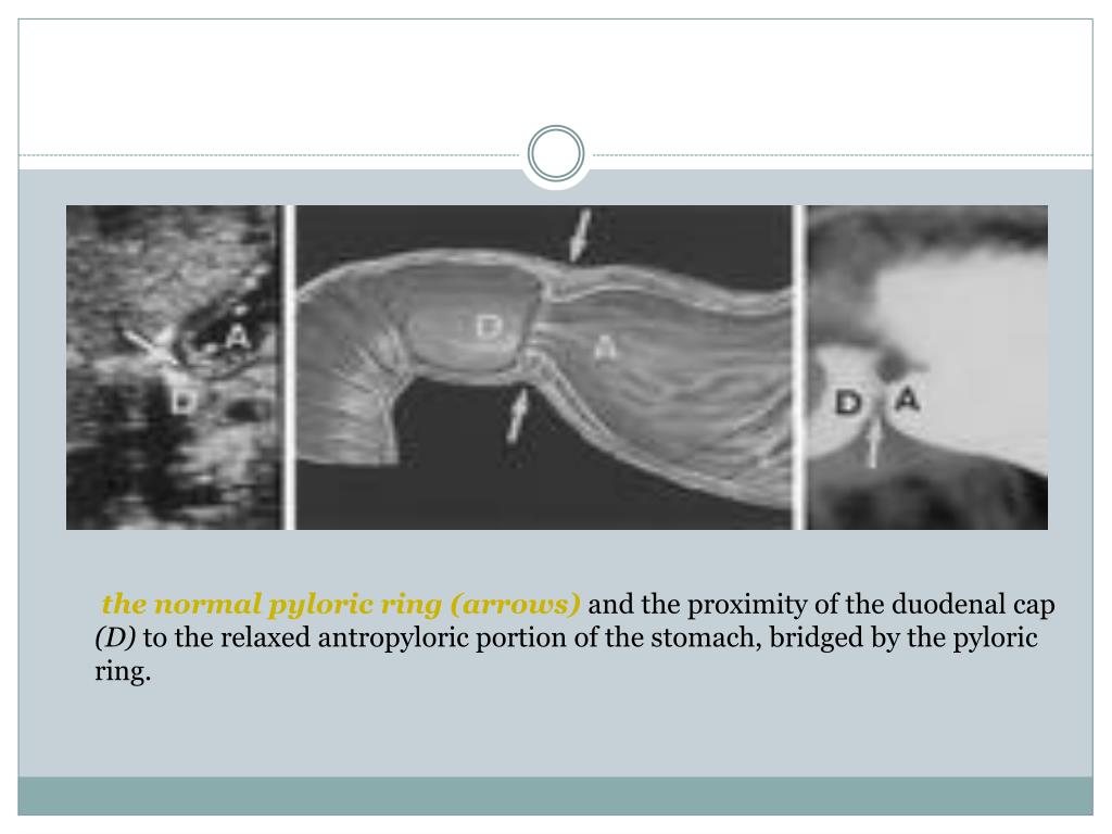 PPT - Gastroesophageal Reflux Disease in Infants PowerPoint ...