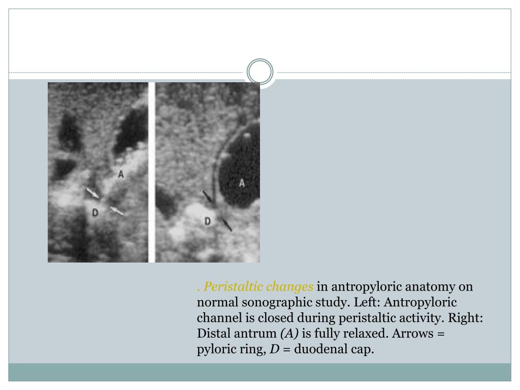 PPT - Gastroesophageal Reflux Disease in Infants PowerPoint ...