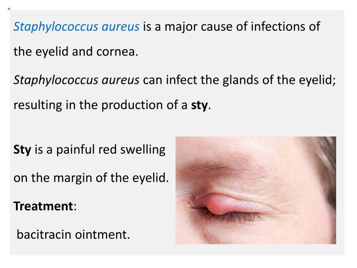 PPT - Otitis media, Otitis externa , and Eye diseases: PowerPoint ...