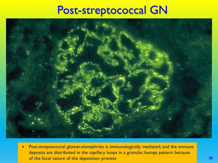 PPT - Acute Glomerulonephritis PowerPoint Presentation - ID:3066382