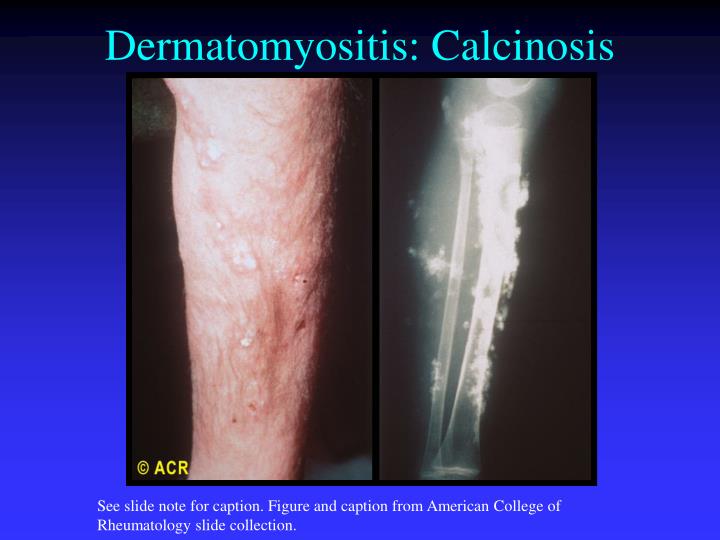 PPT - Dermatomyositis: Muscle Histology PowerPoint Presentation - ID ...