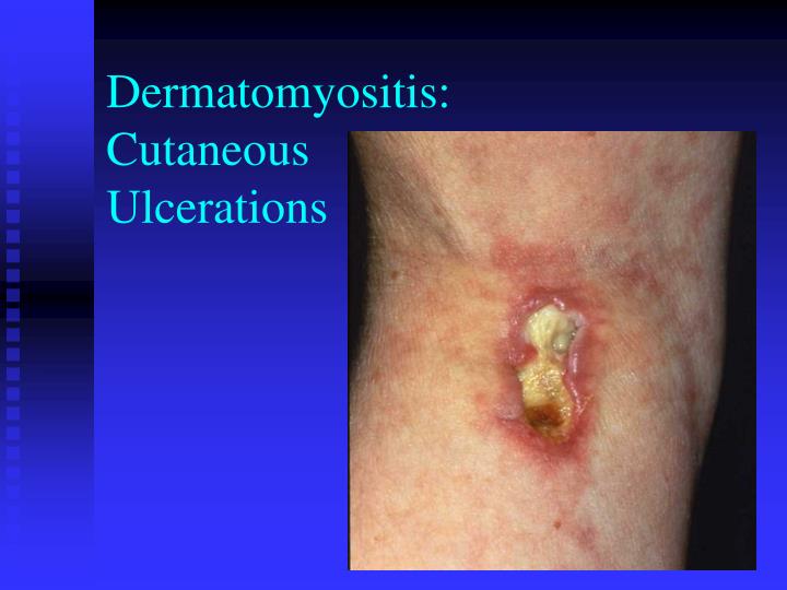 PPT - Dermatomyositis: Muscle Histology PowerPoint Presentation - ID ...