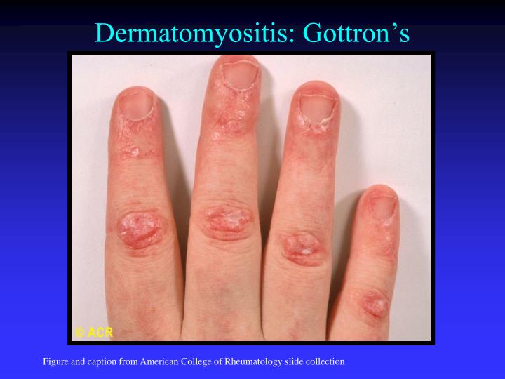 PPT - Dermatomyositis: Muscle Histology PowerPoint Presentation - ID ...
