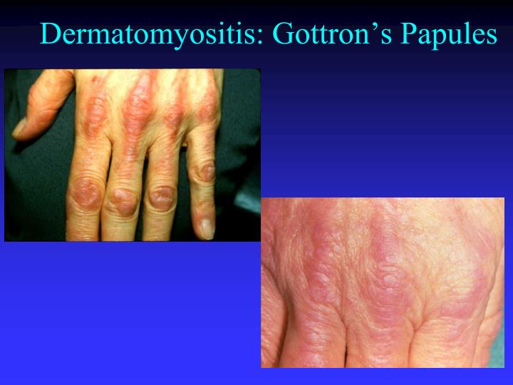 PPT - Dermatomyositis: Muscle Histology PowerPoint Presentation - ID ...