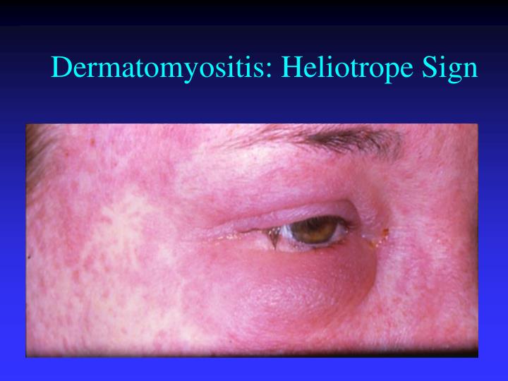 PPT - Dermatomyositis: Muscle Histology PowerPoint Presentation - ID ...