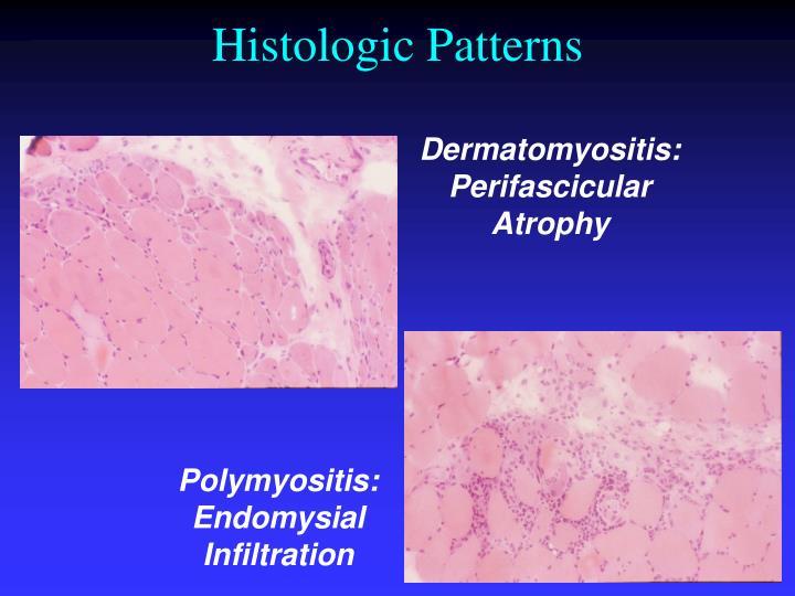 Dermatomyositis Histology