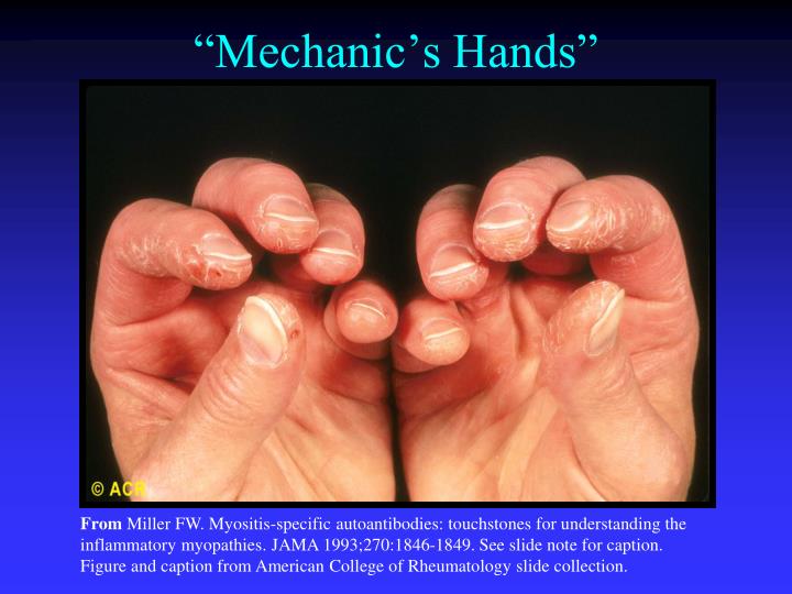 PPT - Dermatomyositis: Muscle Histology PowerPoint Presentation - ID ...