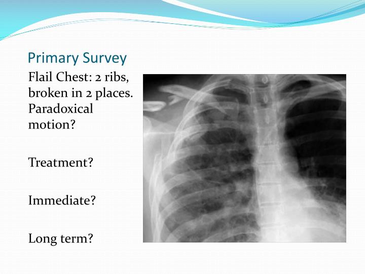 PPT - ATLS, Chapter 4: Thoracic Trauma PowerPoint Presentation - ID:3066590