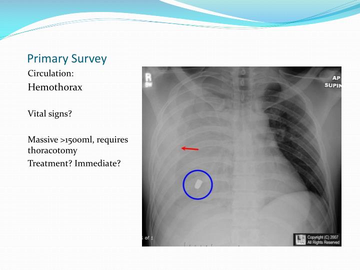 PPT - ATLS, Chapter 4: Thoracic Trauma PowerPoint Presentation - ID:3066590
