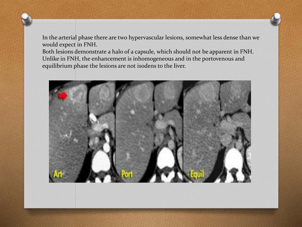 PPT - Liver Incidentalomas What to do with incidentally found lesions ...