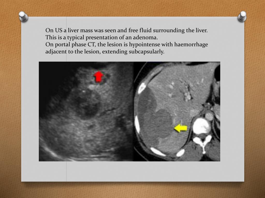 PPT - Liver Incidentalomas What to do with incidentally found lesions ...