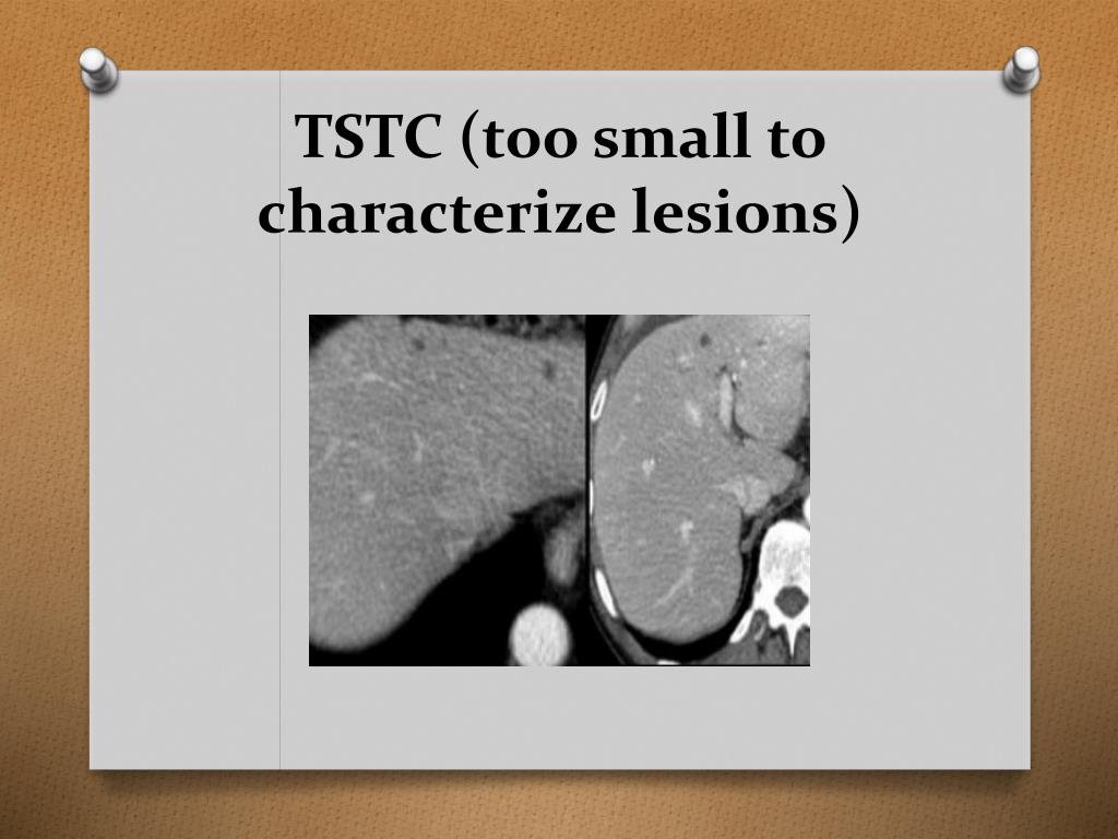 PPT - Liver Incidentalomas What to do with incidentally found lesions ...